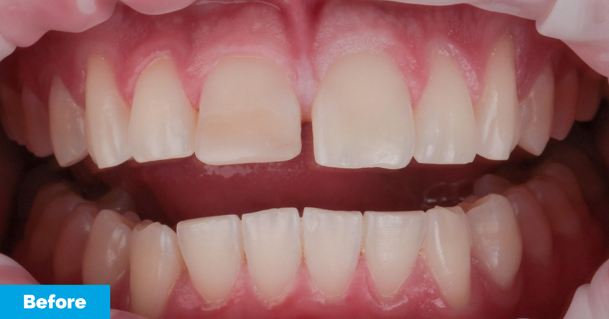 Jason’s Smile Makeover Journey | Oralux Dental